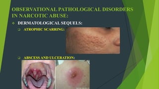 Narcotics and Pathology of Drug Abuse | PPTX