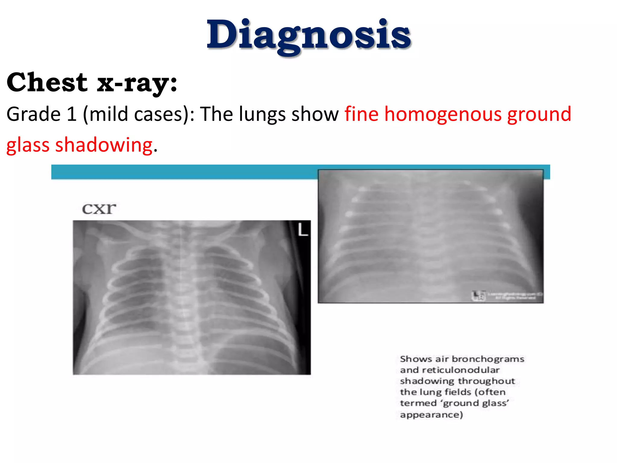 NEONATAL RESPIRATORY DISTRESS SYNDROME | PPTX
