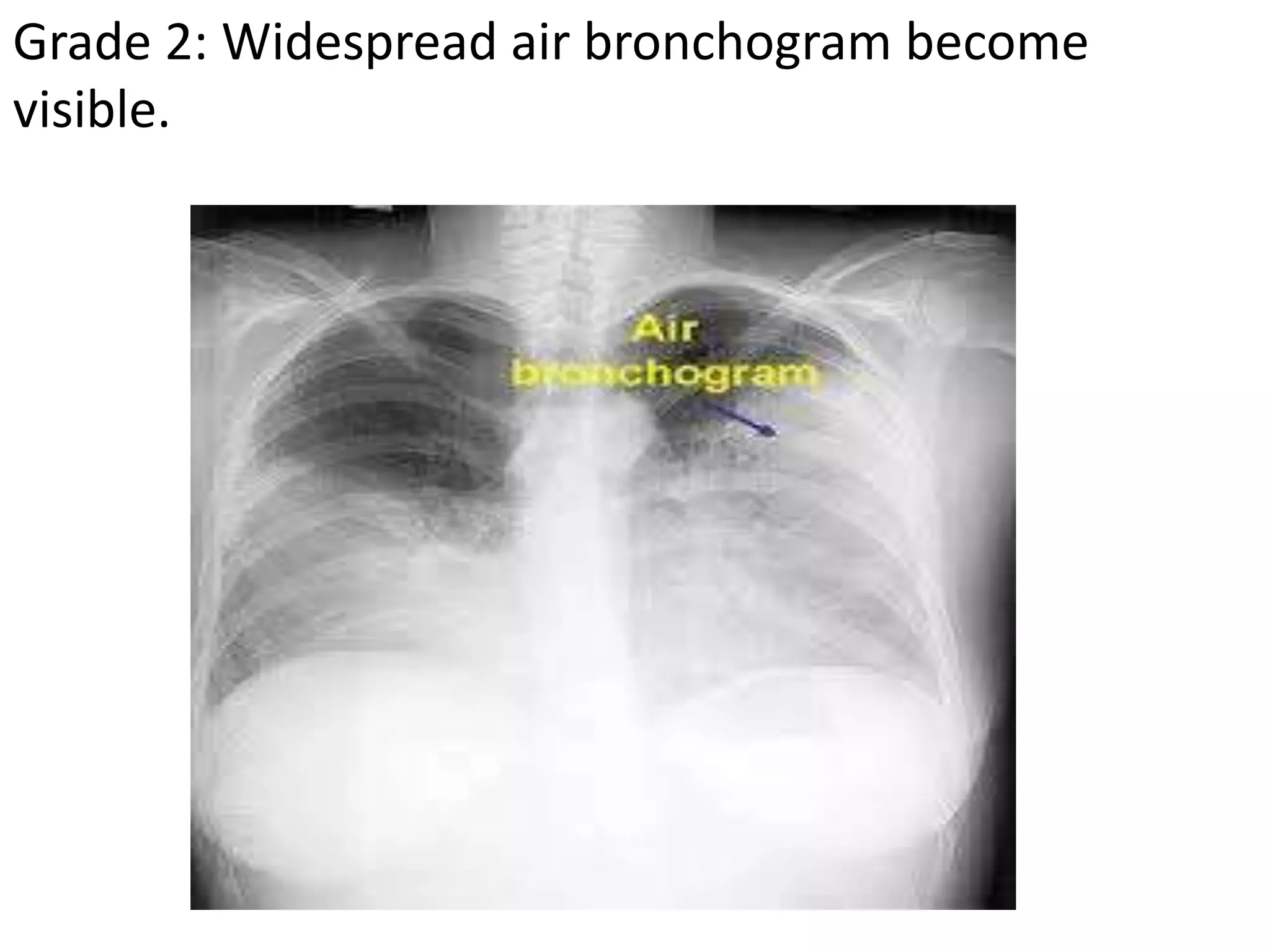 NEONATAL RESPIRATORY DISTRESS SYNDROME | PPTX