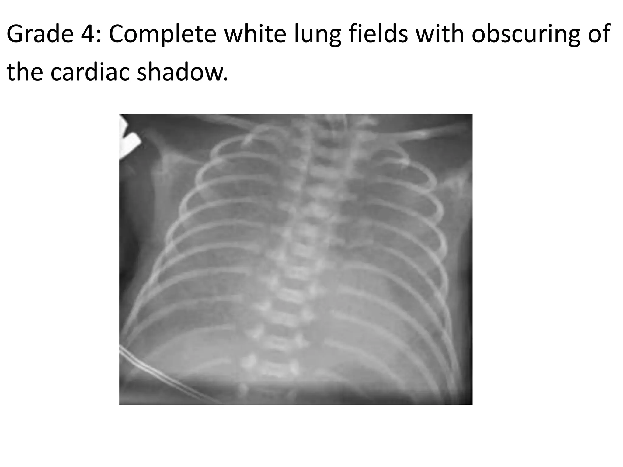 NEONATAL RESPIRATORY DISTRESS SYNDROME | PPTX