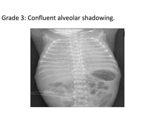 NEONATAL RESPIRATORY DISTRESS SYNDROME | PPTX