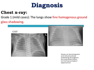 Respiratory Distress Syndrome X Ray