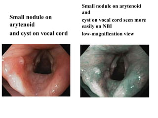 Narrow band imaging | PPTX