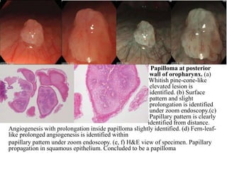 Narrow band imaging | PPTX