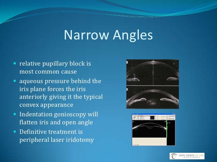 Narrow angles