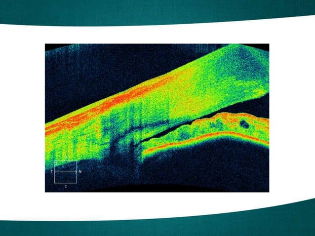 Narrow angles talk | PPT