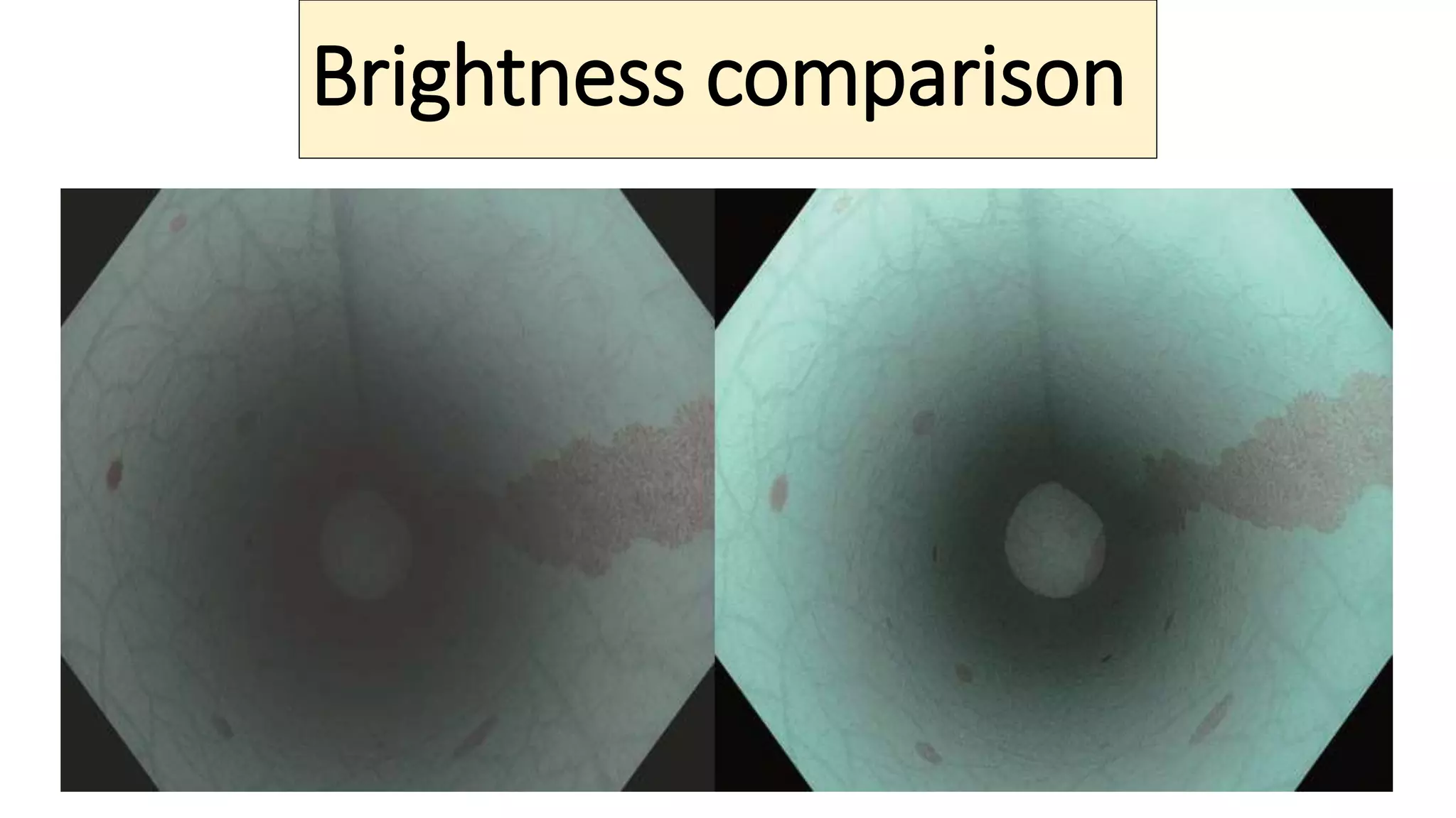 Narrow band imaging | PPTX