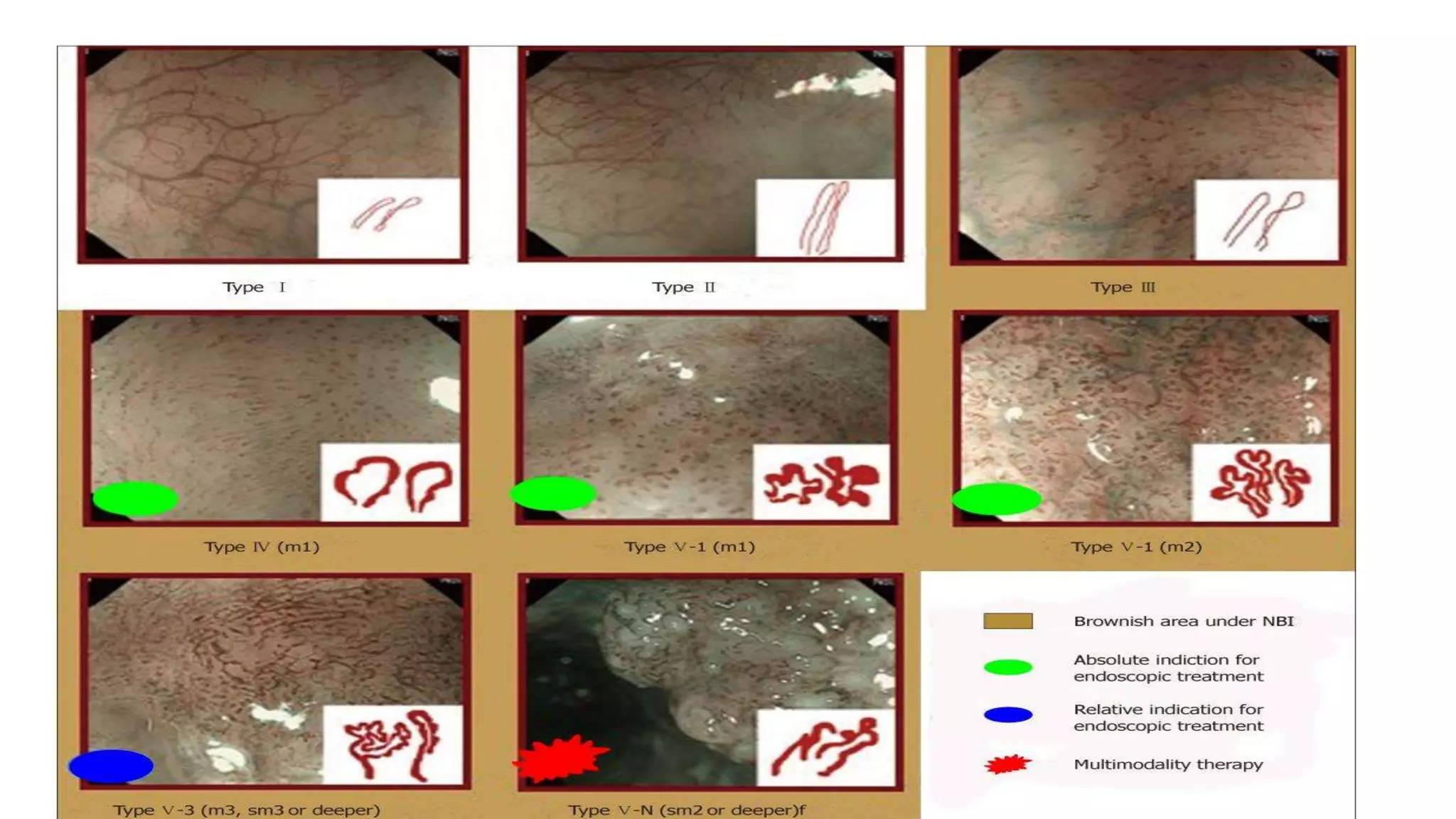 Narrow band imaging | PPTX