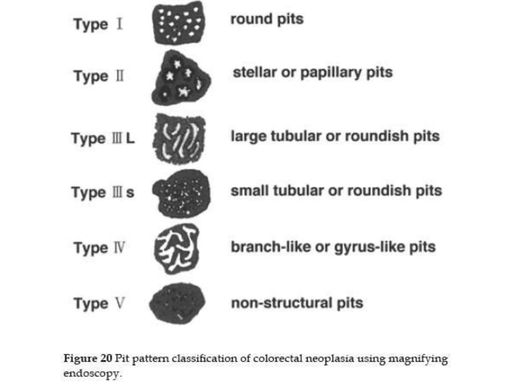 Narrow band imaging(nbi) in ent -Dr.Ashly Alexander | PPTX