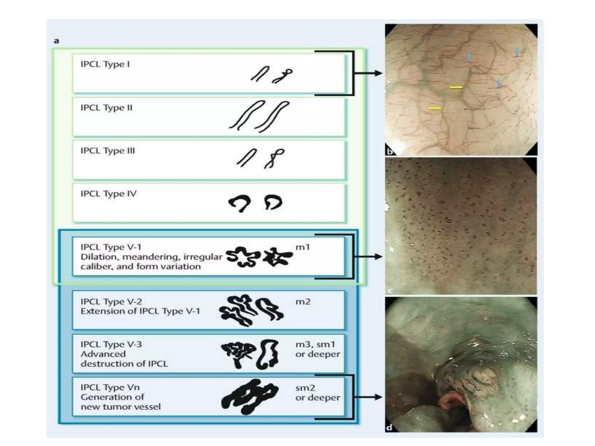 Narrow band imaging(nbi) in ent -Dr.Ashly Alexander | PPTX