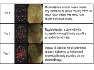 Narrow band imaging(nbi) in ent -Dr.Ashly Alexander | PPTX