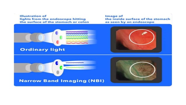 Narrow band imaging techniques in detecting GIT lesions.pptx