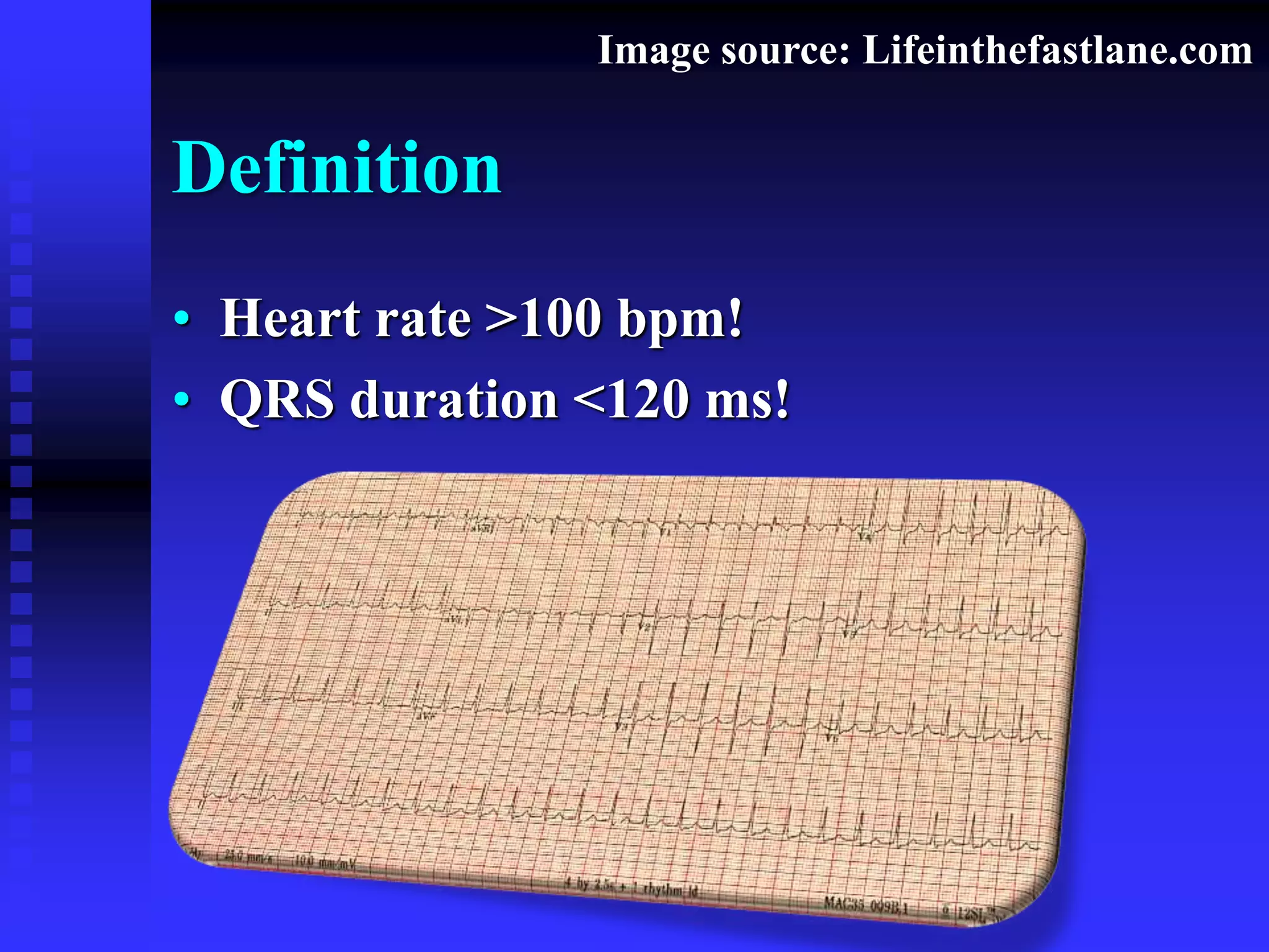 Narrow complex tachycardia | PPSX