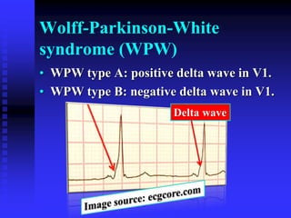 Narrow complex tachycardia | PPSX