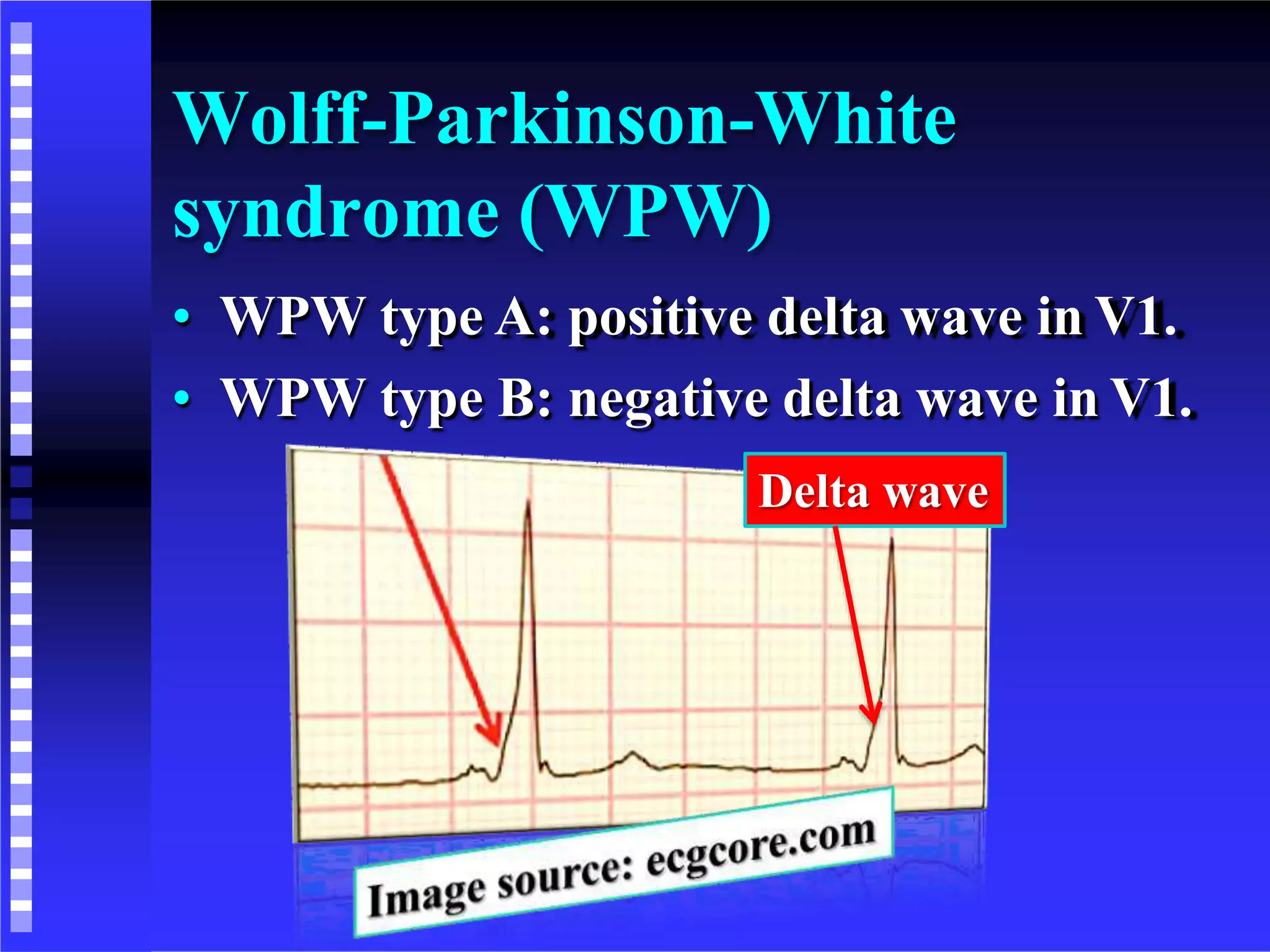 narrowcomplextachycardia.pptx