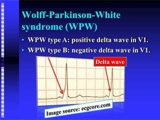 narrowcomplextachycardia.pptx