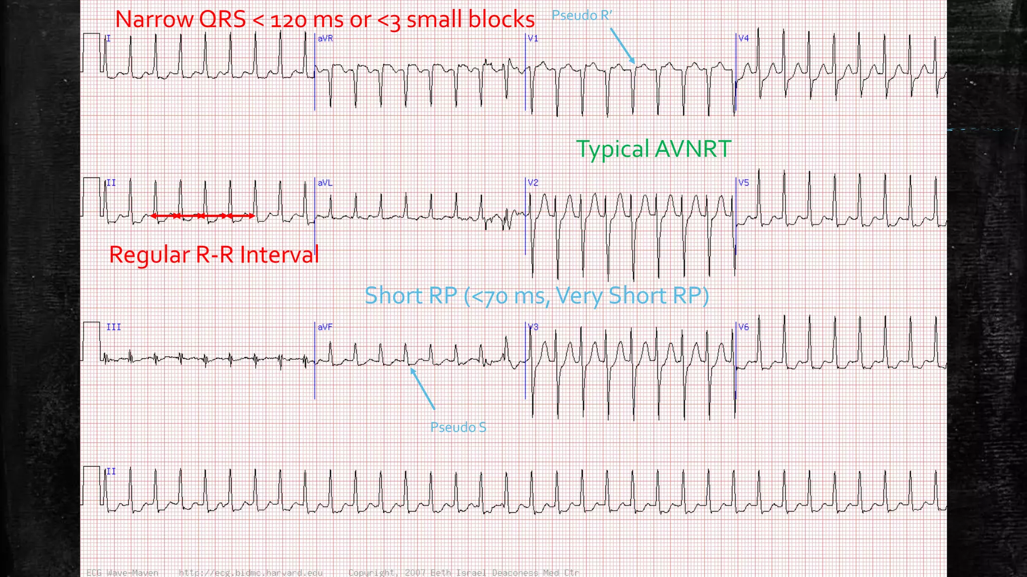 Approach to Narrow complex tachycardia | PPTX
