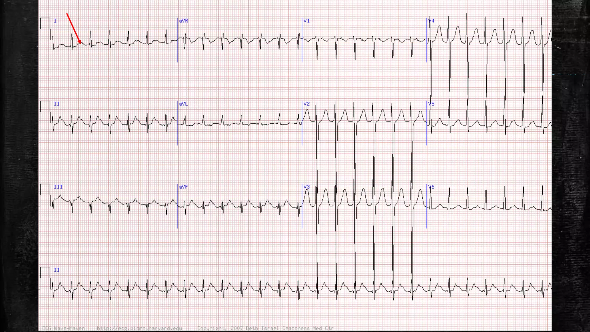 Approach to Narrow complex tachycardia | PPTX
