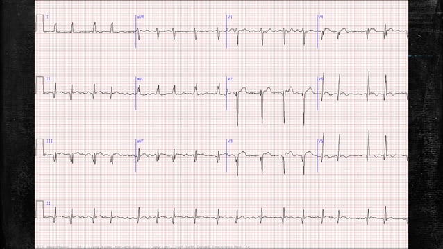 Approach to Narrow complex tachycardia | PPTX
