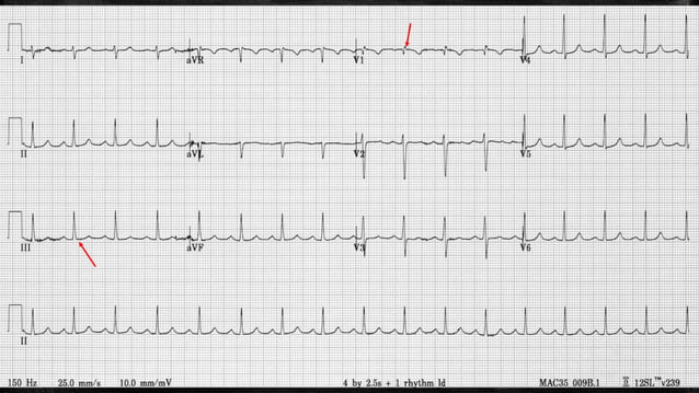 Approach to Narrow complex tachycardia | PPTX