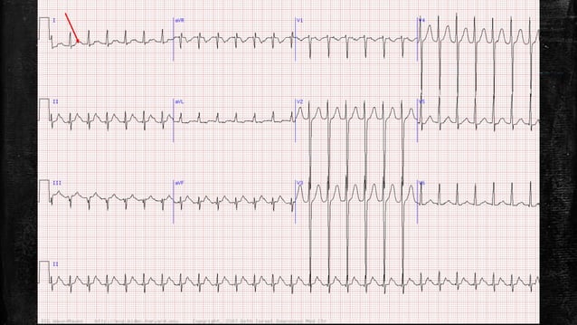Approach to Narrow complex tachycardia | PPTX
