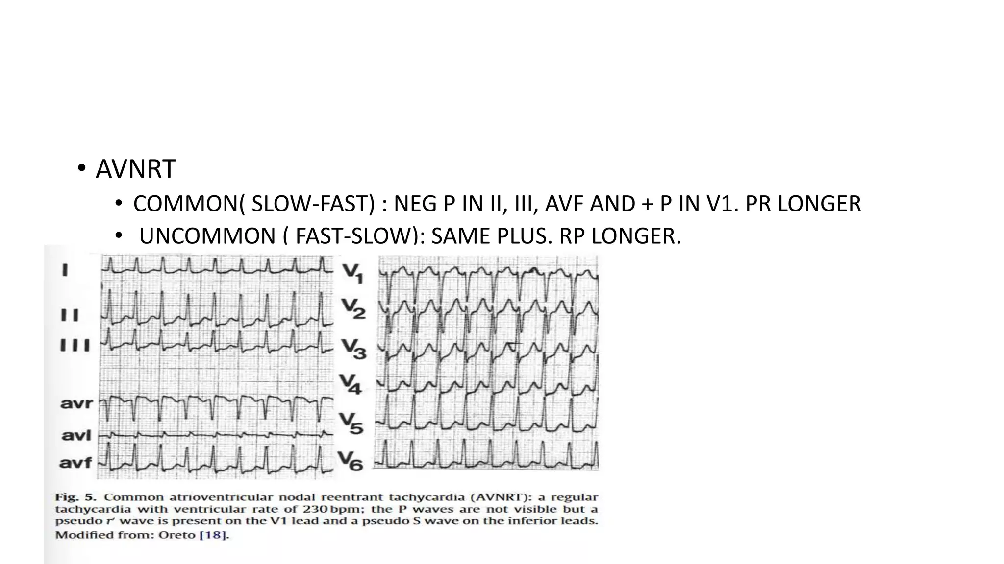 Narrow complex tachycardia algorithm.pptx