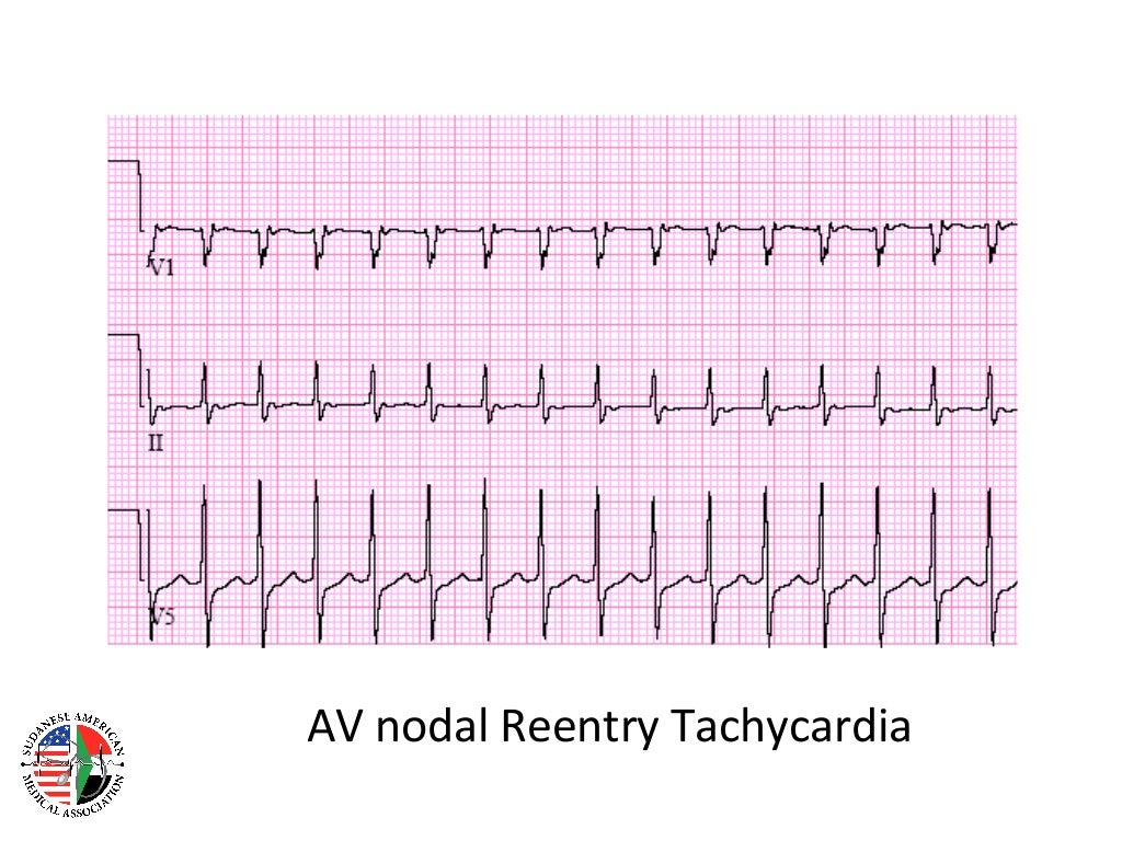 Narrow complex tachycardias