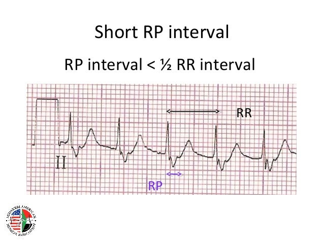Narrow complex tachycardias
