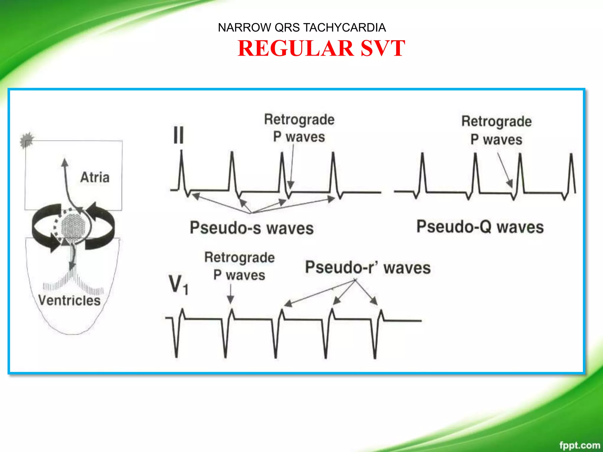 Narrow qrs tachy i.tammi raju | PPT