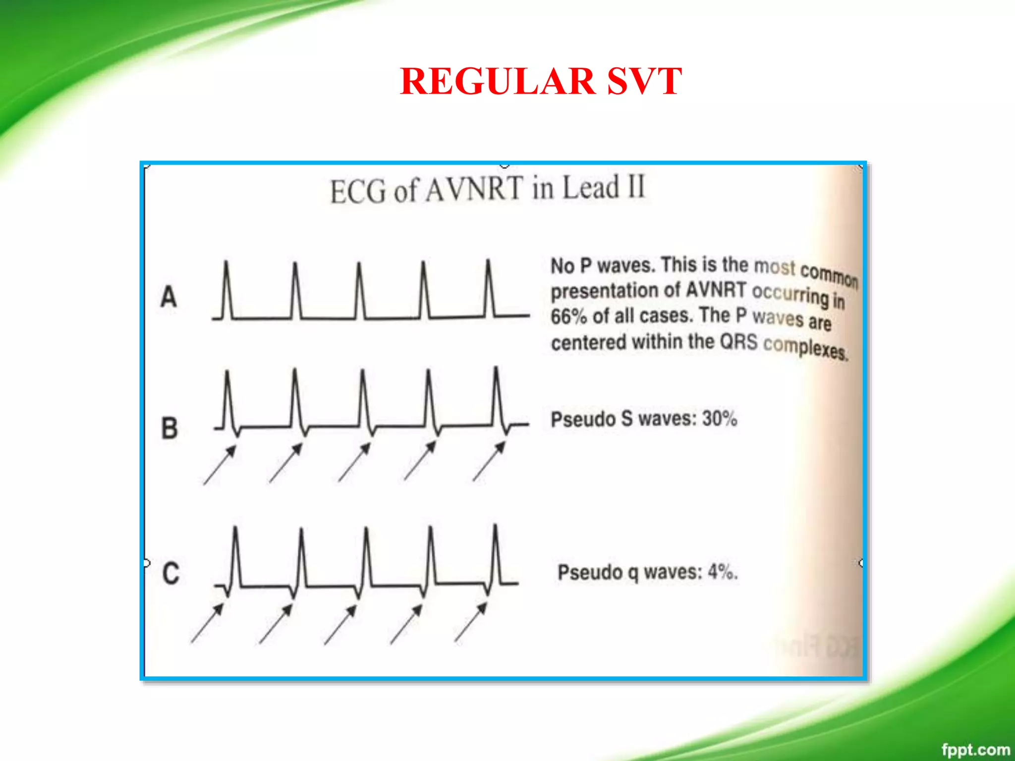 Narrow qrs tachy i.tammi raju | PPT