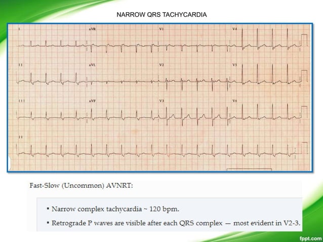 Narrow qrs tachy i.tammi raju | PPT
