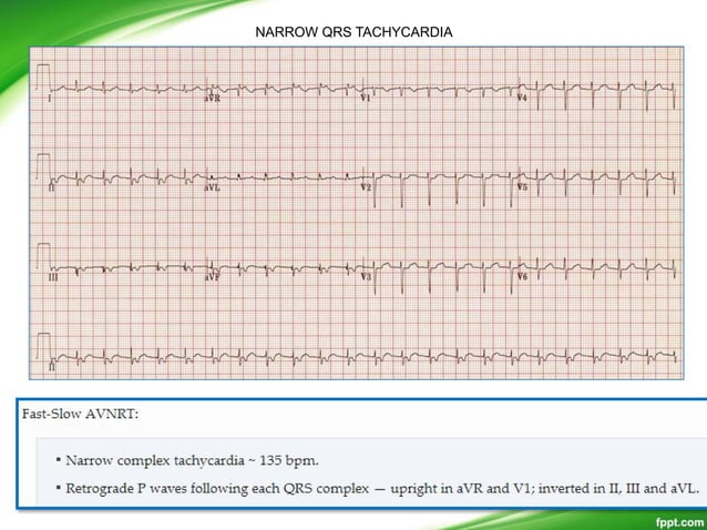 Narrow qrs tachy i.tammi raju | PPT