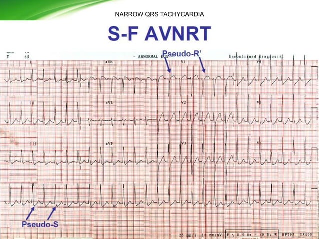 Narrow qrs tachy i.tammi raju | PPT