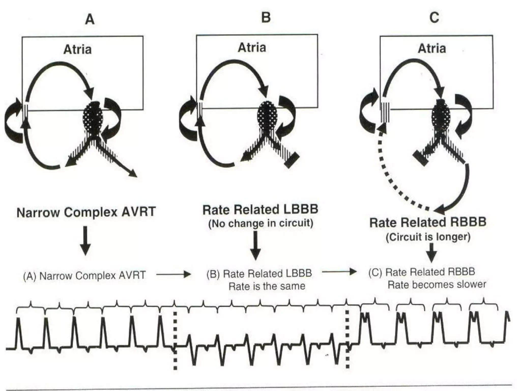 Narrow QRS Tachycardia | PPT