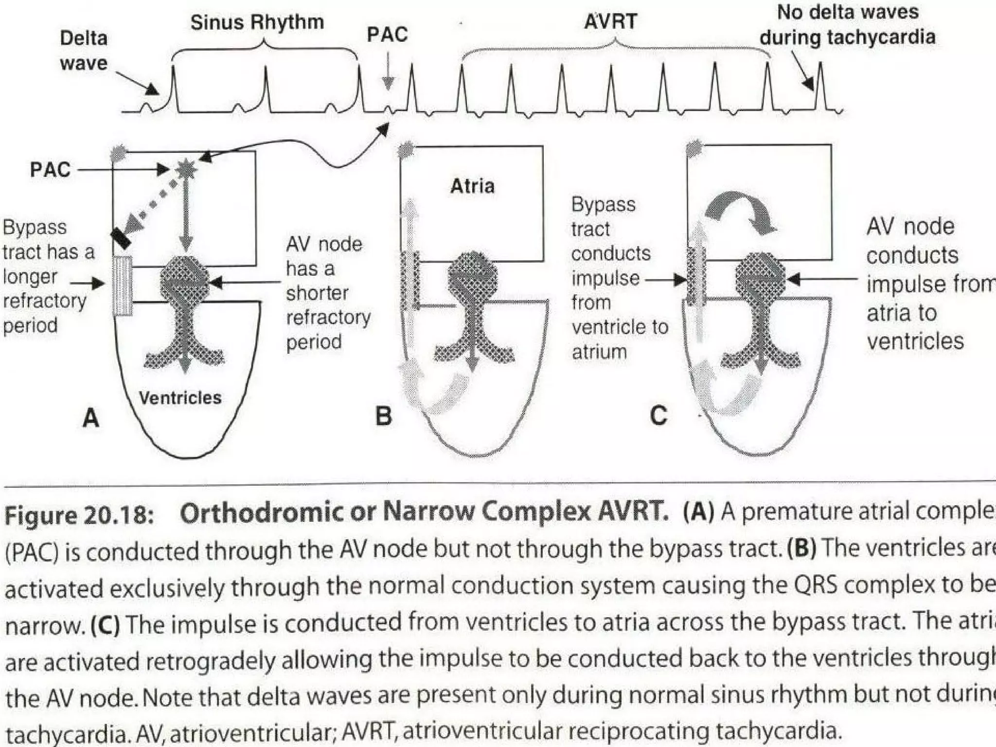 Narrow QRS Tachycardia | PPT