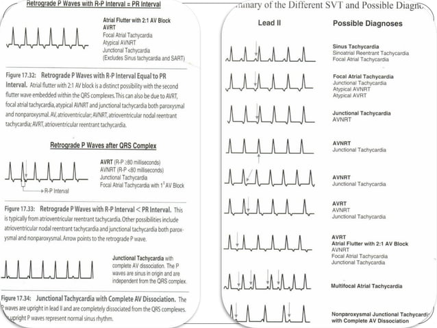 Narrow QRS Tachycardia | PPT