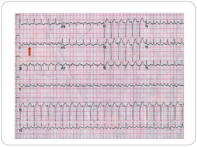 Narrow QRS Tachycardia | PPT