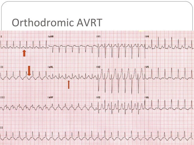 Narrow QRS Tachycardia | PPT