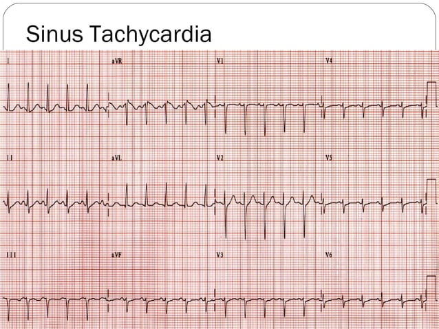 Narrow QRS Tachycardia | PPT
