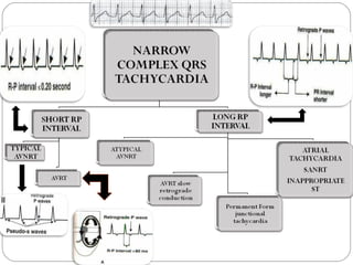 Narrow QRS Tachycardia | PPT