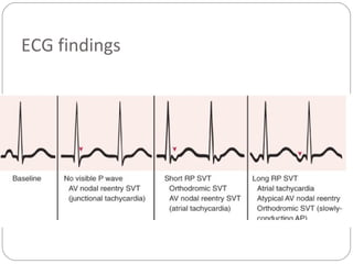 Narrow Qrs Complex