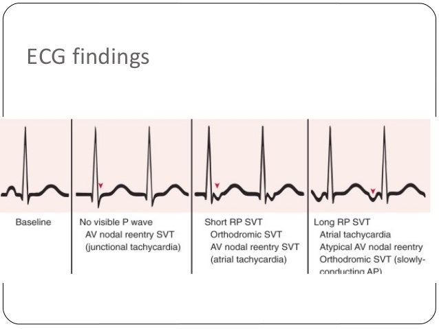 Narrow QRS Tachycardia