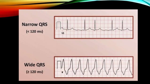 Narrow QRS Tachycardia diagnosis and treatment.pptx