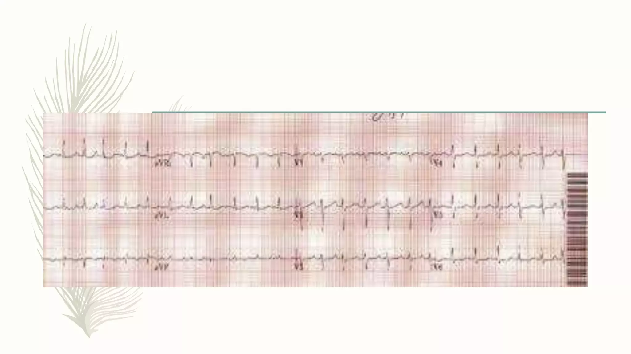 Narrow qrs tachycardia part 1 | PPT