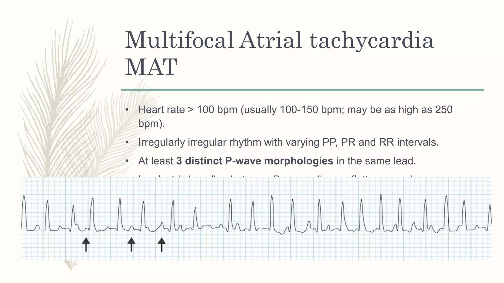 Narrow qrs tachycardia part 1 | PPT