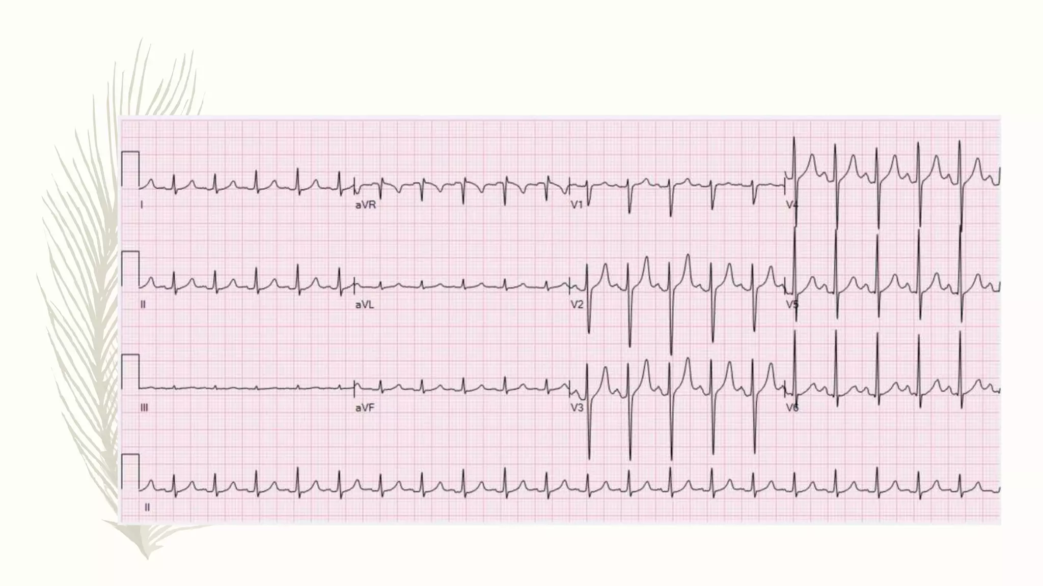 Narrow qrs tachycardia part 1 | PPT
