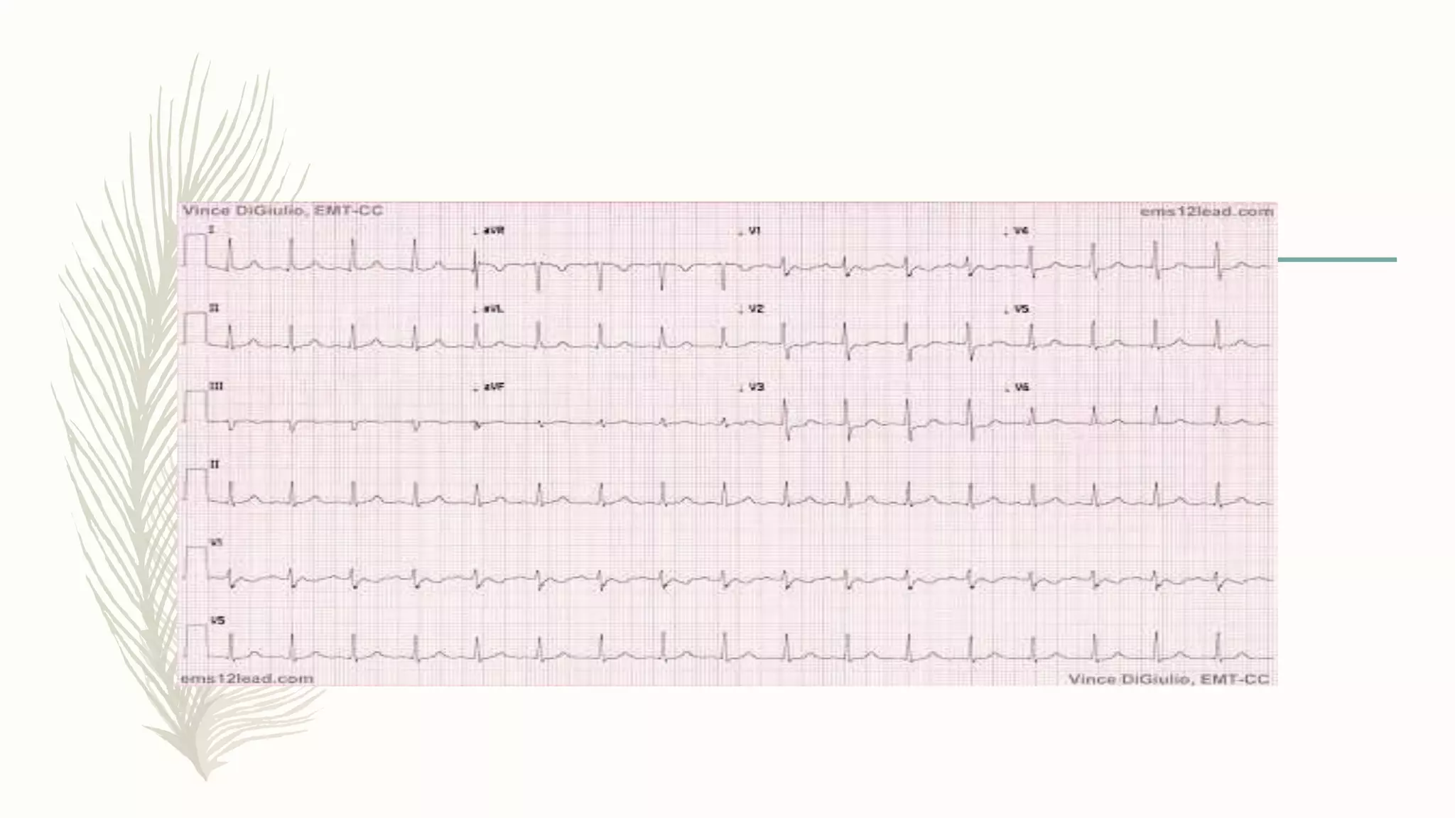 Narrow qrs tachycardia part 1 | PPT