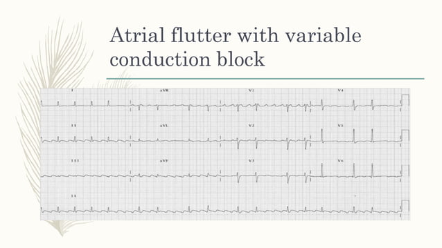 Narrow qrs tachycardia part 1 | PPT