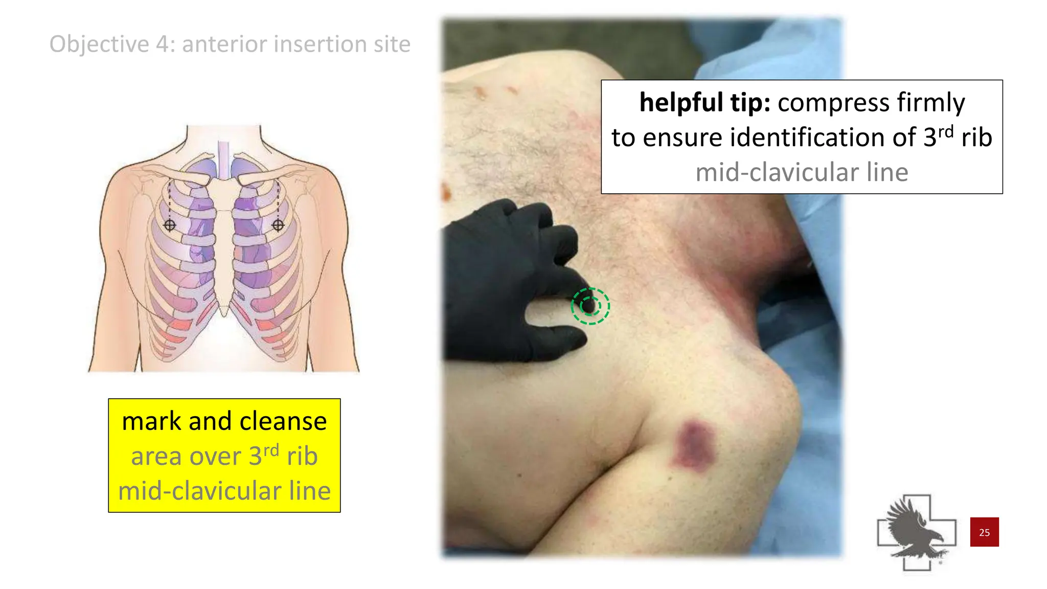 Power point of needle chest compressions | PPTX