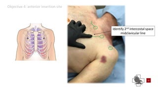 Power point of needle chest compressions | PPTX